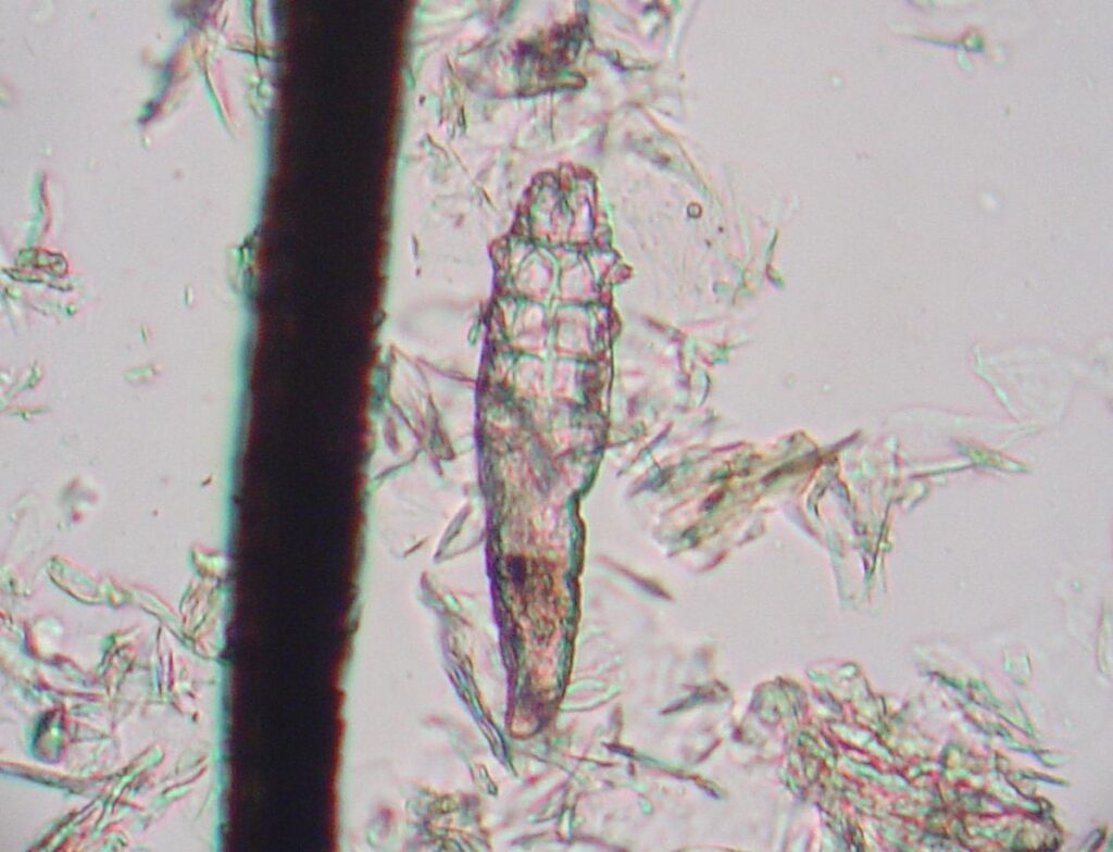 Mites on Your Face: The Microscopic Insects That Live in Your Pores ...