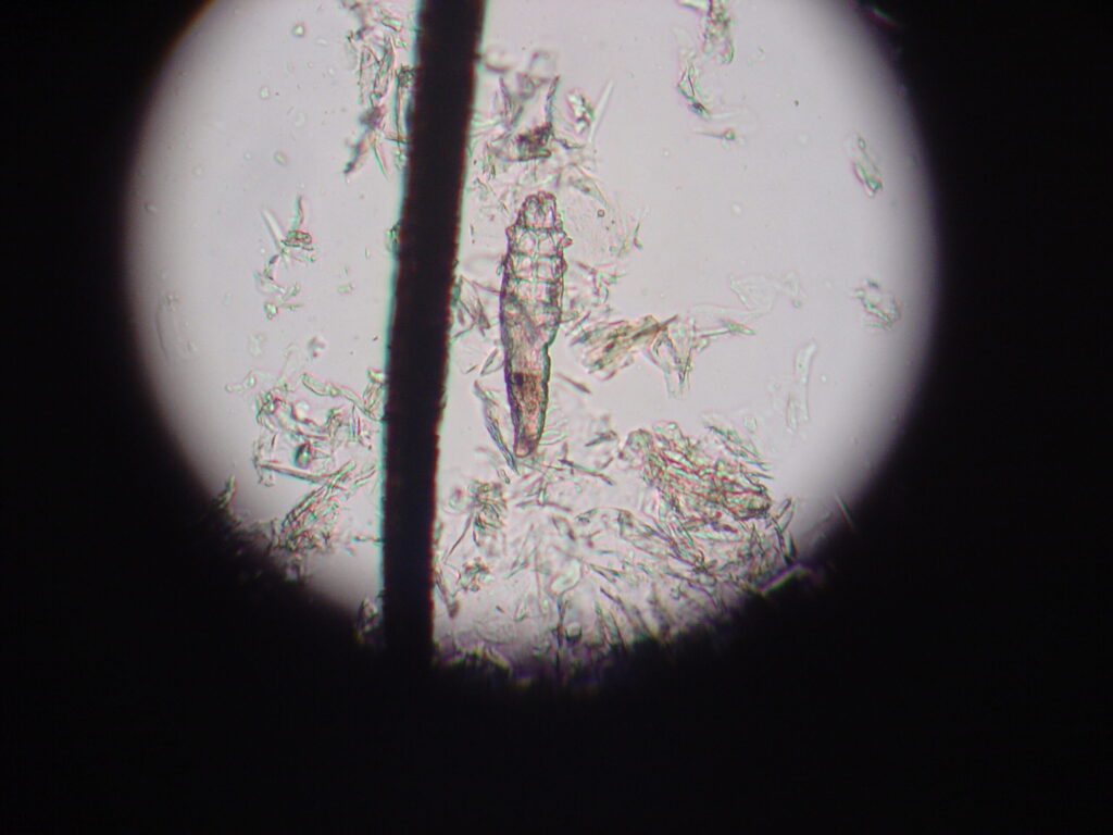 Mites on Your Face: The Microscopic Insects That Live in Your Pores ...