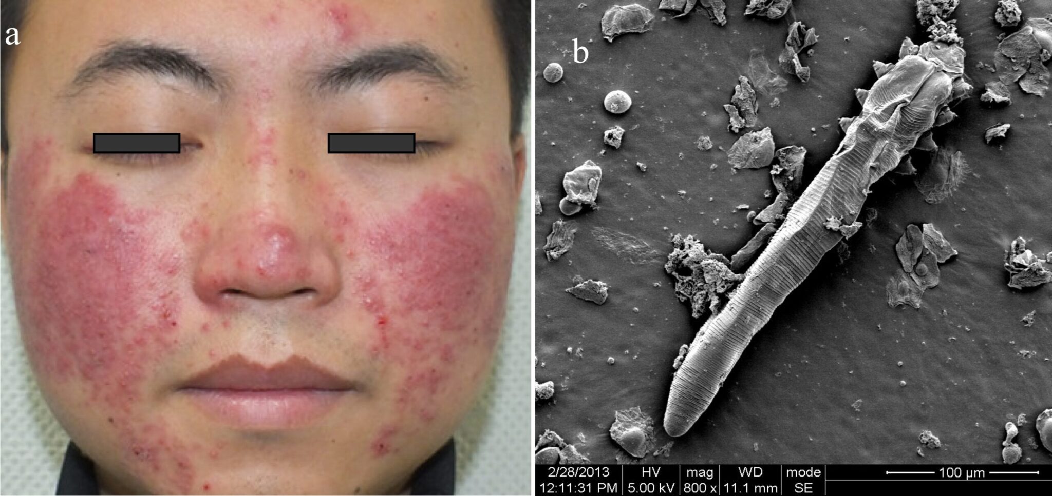 Mites on Your Face: The Microscopic Insects That Live in Your Pores ...